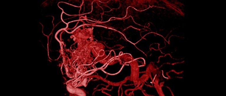 Angiom | Neurochirurgie Innsbruck & Hall in Tirol